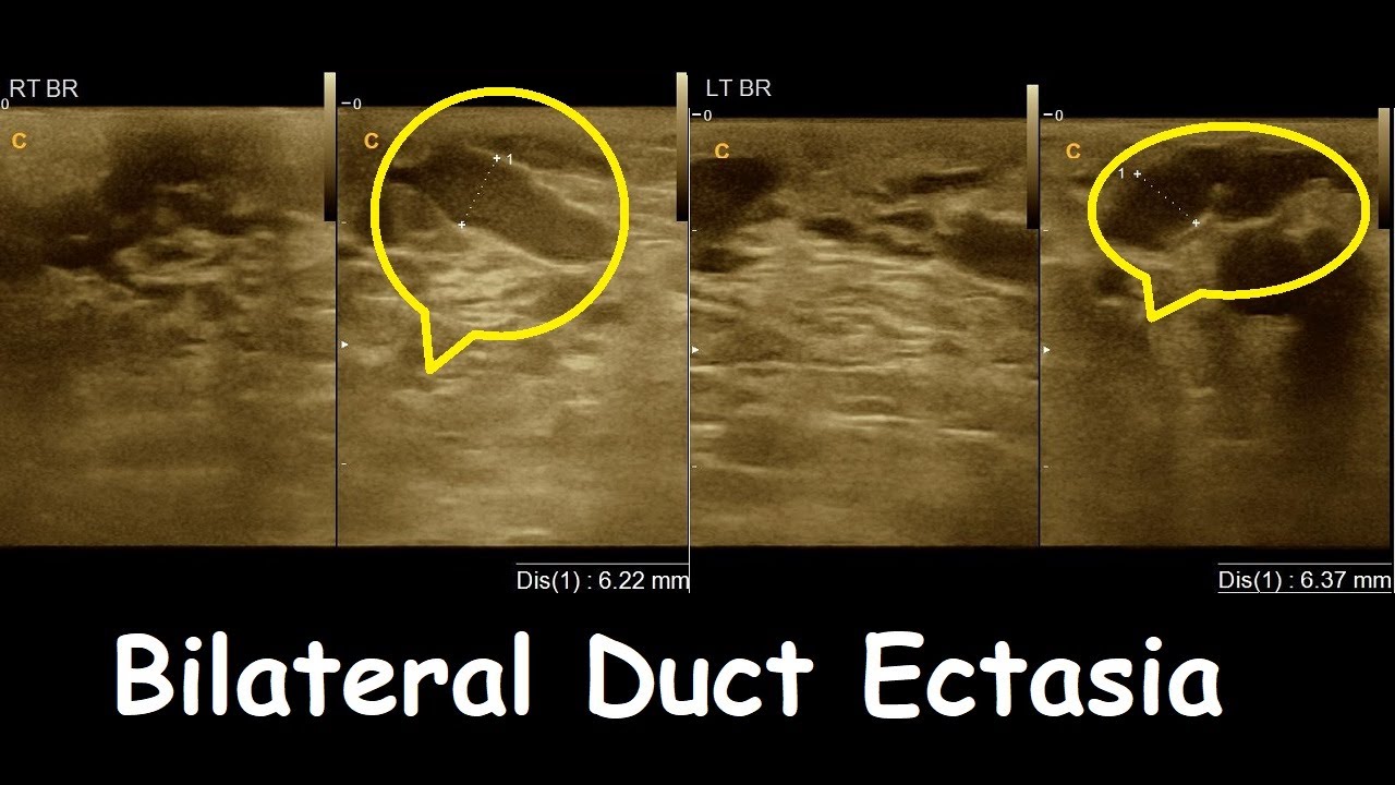 Bilateral duct ectasia | Breast Report | Amader hospital | Ultrasound ...