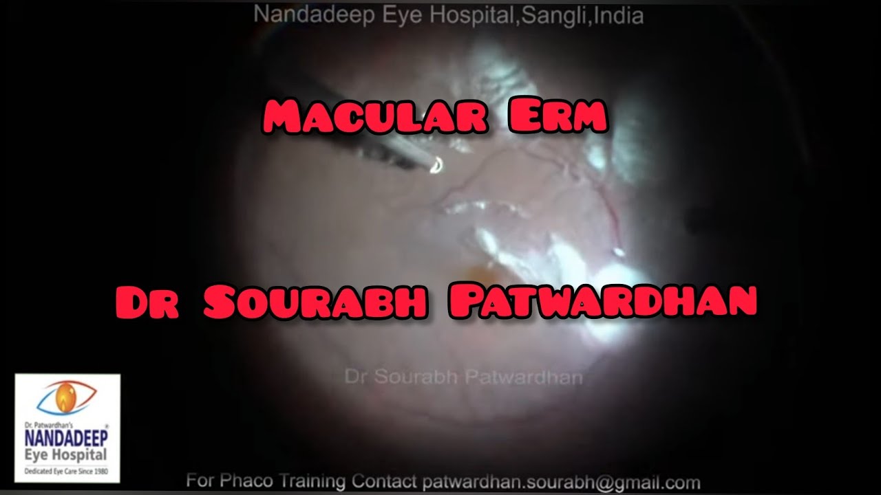 Macular ERM Dr Sourabh Patwardhan Live Retina surgery. For Info about ...