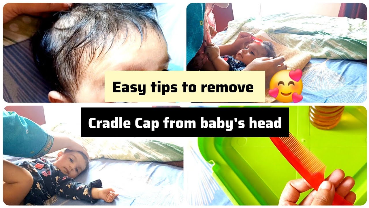 HOW TO REMOVE CRADLE CAP FROM BABY HEAD👶🏻 || VERY SIMPLE TRICK ️ - YouTube