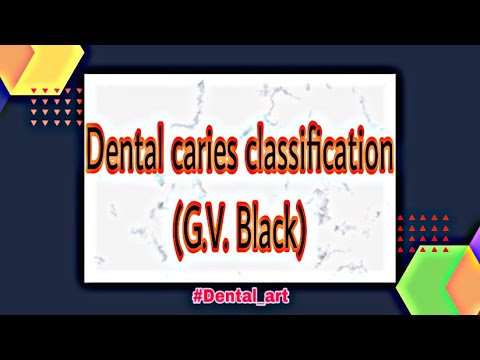 Dental caries classification: G.V. Black system - YouTube