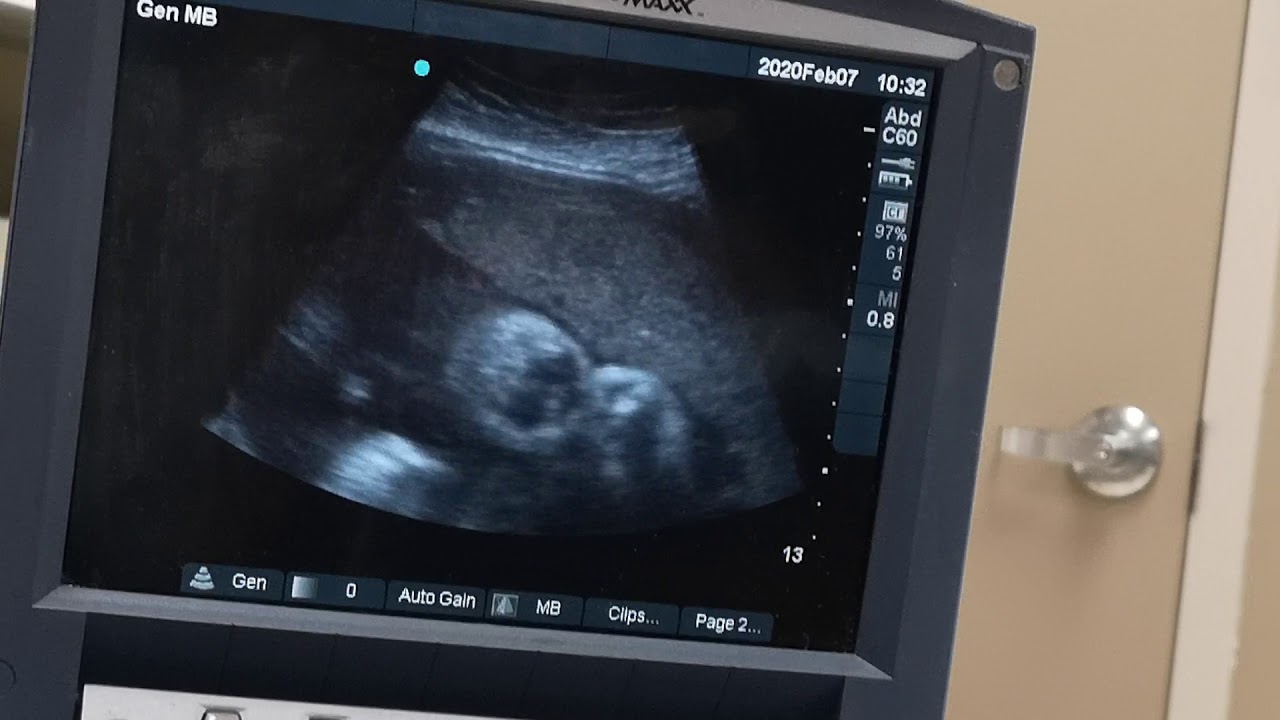 Al's 34 week ultrasound. - YouTube