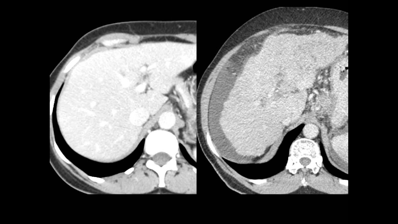 [AULA] Anat radiológica hepática e hepatopatias difusas | CT liver anat ...