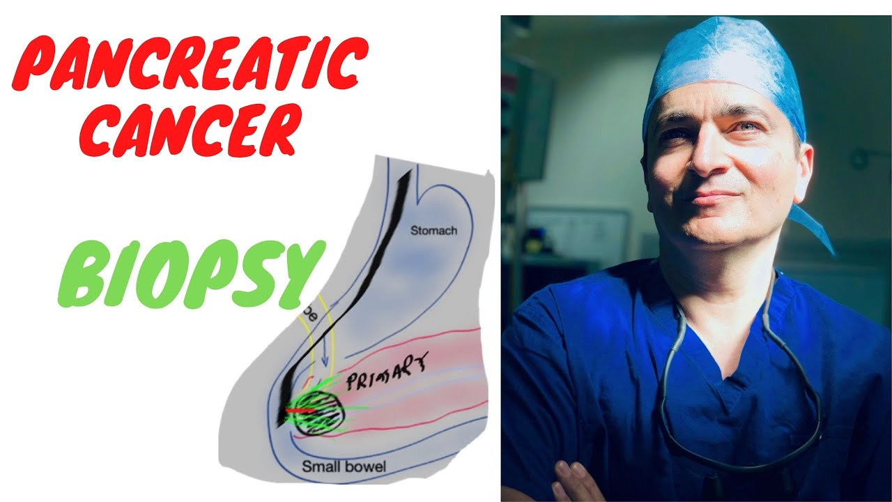 Pancreatic Cancer - Biopsy (when, why, how) - YouTube