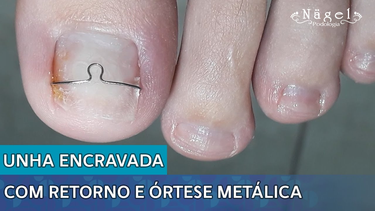 órtese Metálica Para Unhas - EDUCA