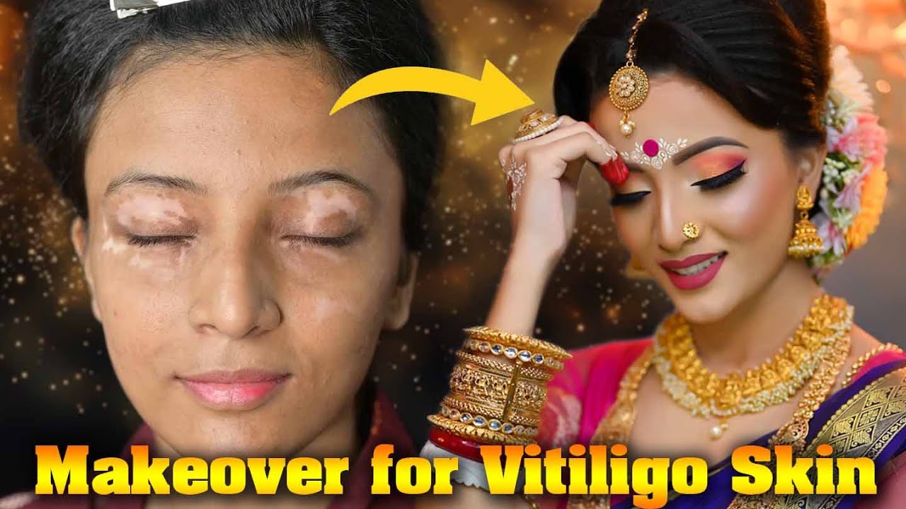 Vitiligo Skin Makeover - Magical Transformation - Unbelievable Before ...