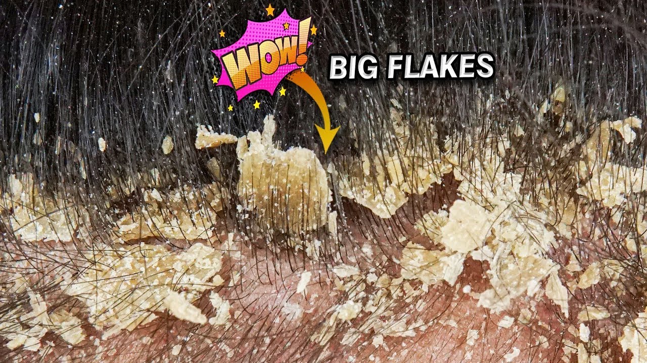 Scratching Dandruff Off Scalp Big Flakes Dandruff Removal Youtube