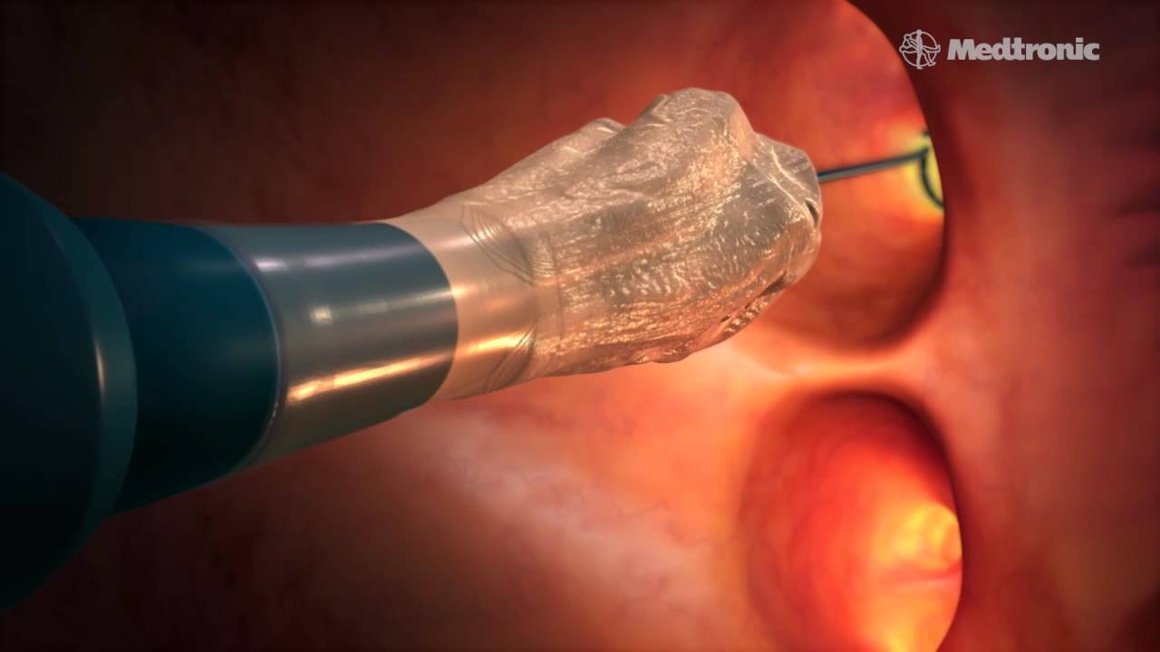 Medtronic Arctic Front Advance Cryoballoon Animation - YouTube