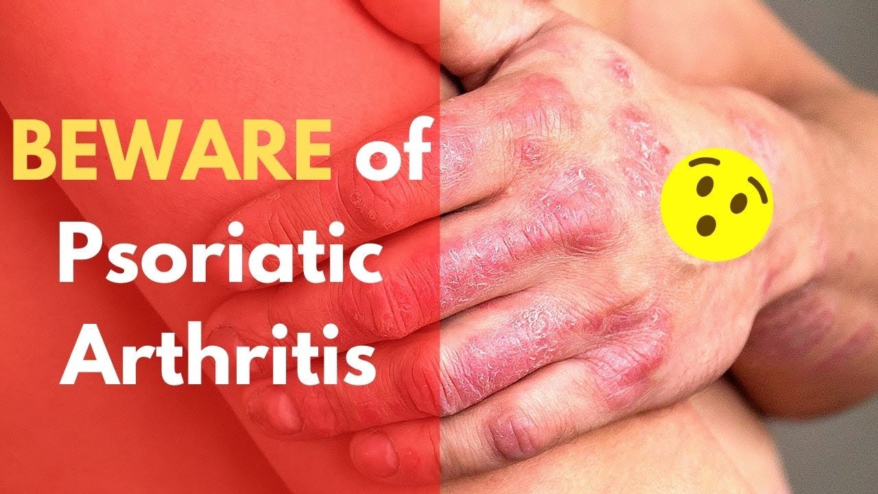 Psoriasis Arthritis Symptoms And Signs Beware Of Psoriatic Arthritis Youtube