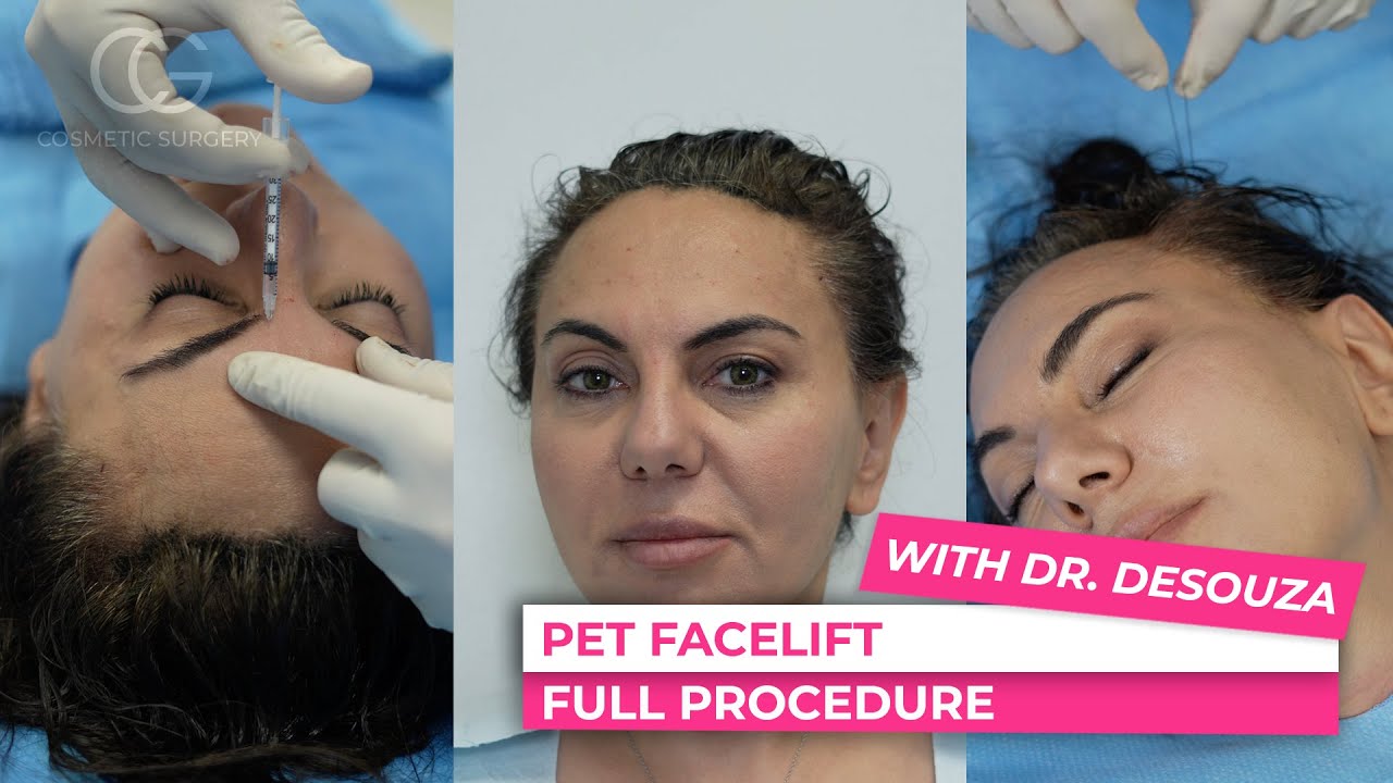 Face PET Lift : Point of Elevation Tissue (Surgery Explained) 😱 - CG ...