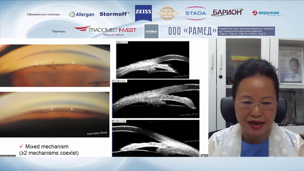 What are the mechanisms of angle closure? Do we consider all of them in ...