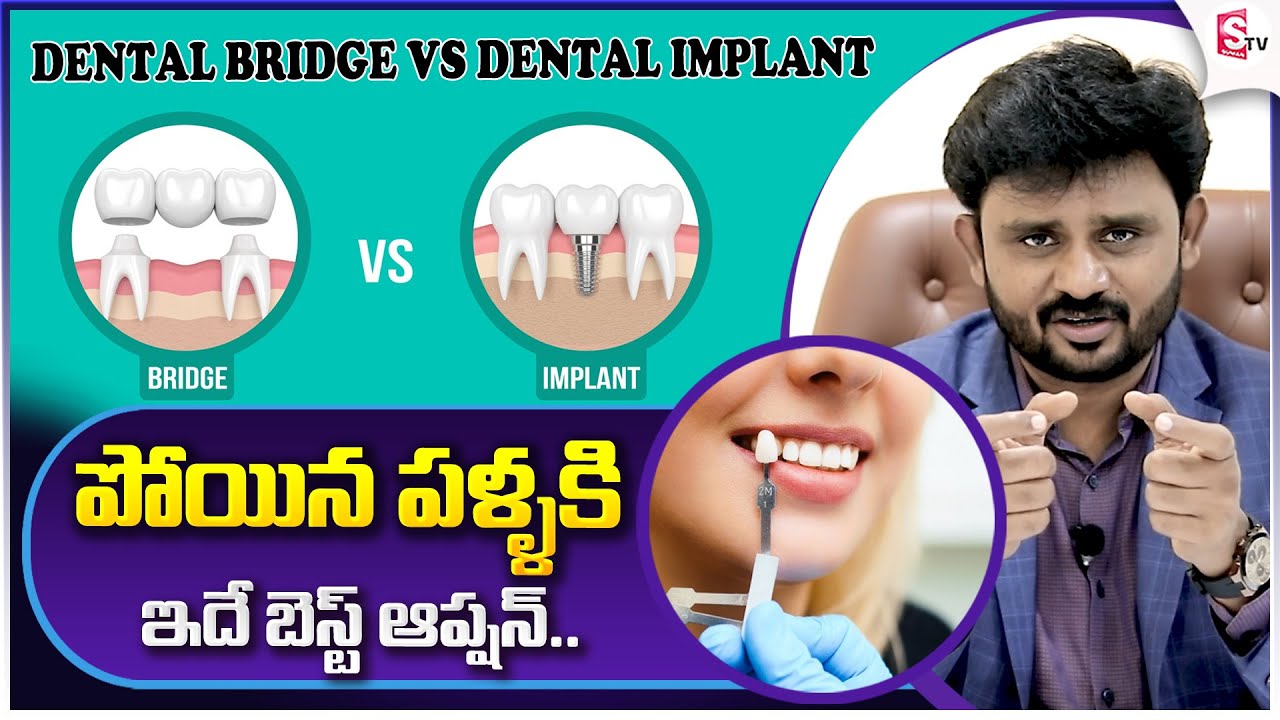 Dental Implant vs Tooth Bridge In Telugu | NDC Dental Bridges Its ...