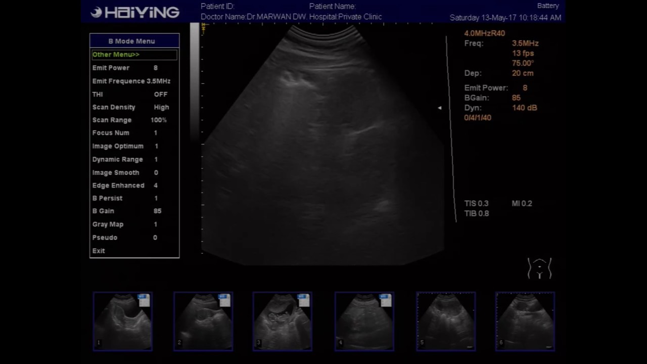 Ultrasound.Accessory spleen(splenule). - YouTube