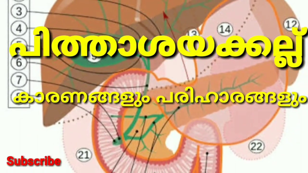 പിത്താശയക്കല്ല് എങ്ങനെ മാറ്റാം///Gallbladder stones reason and remedies ...
