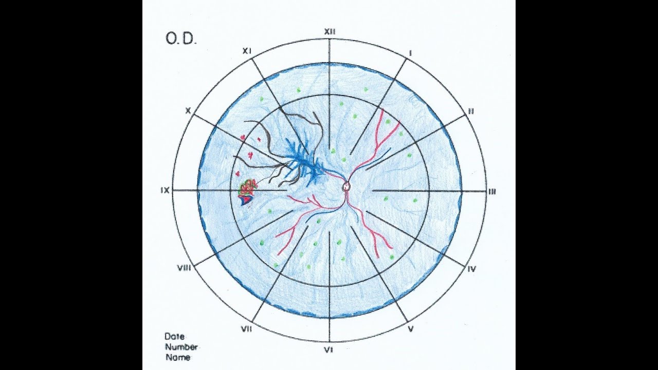 Complete retinal detachment with PVR secondary to branch retinal vein ...