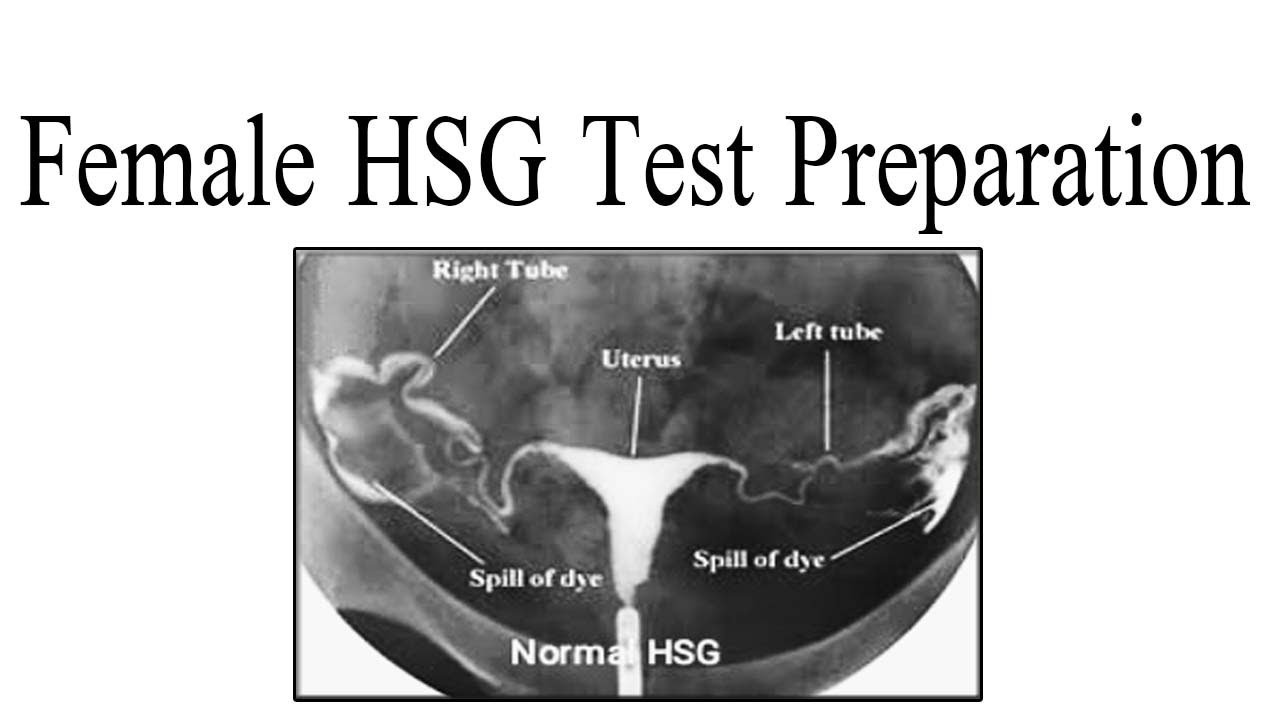 HSG Preparation For A Hysterosalpingogram Procedure YouTube