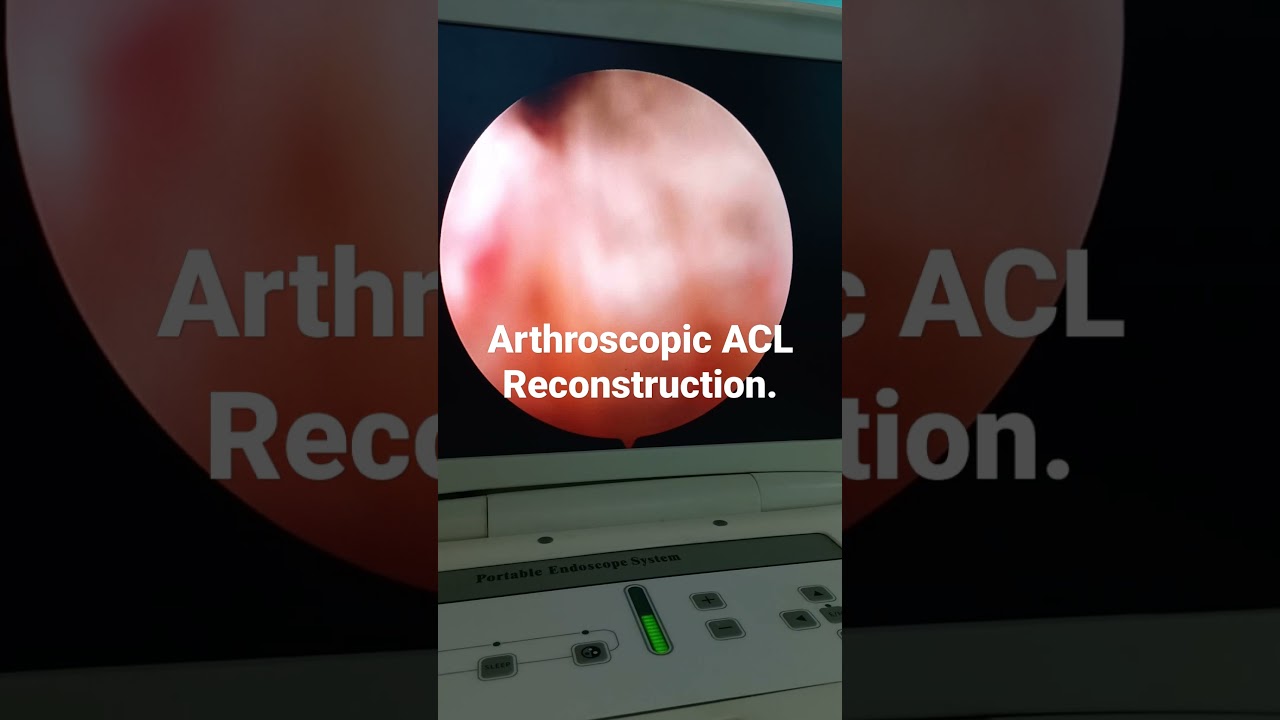 Arthroscopic Knee ACL Reconstruction using Hamstring graft and ...