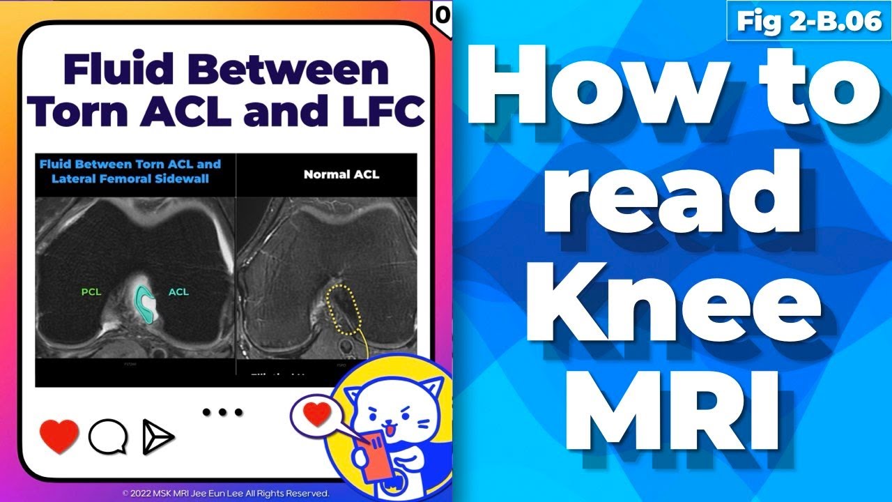 (Fig 2-B.06) Fluid between torn ACL and lateral femoral condyle ...