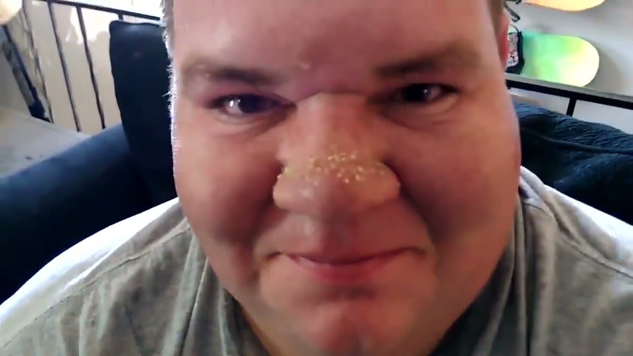 The Top 5 Satisfying Pimple Popping Videos That Will Make You Squirm ...