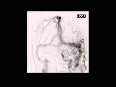 Endovascular treatment of complex dural arteriovenous fistula using the dual-microcatheter technique