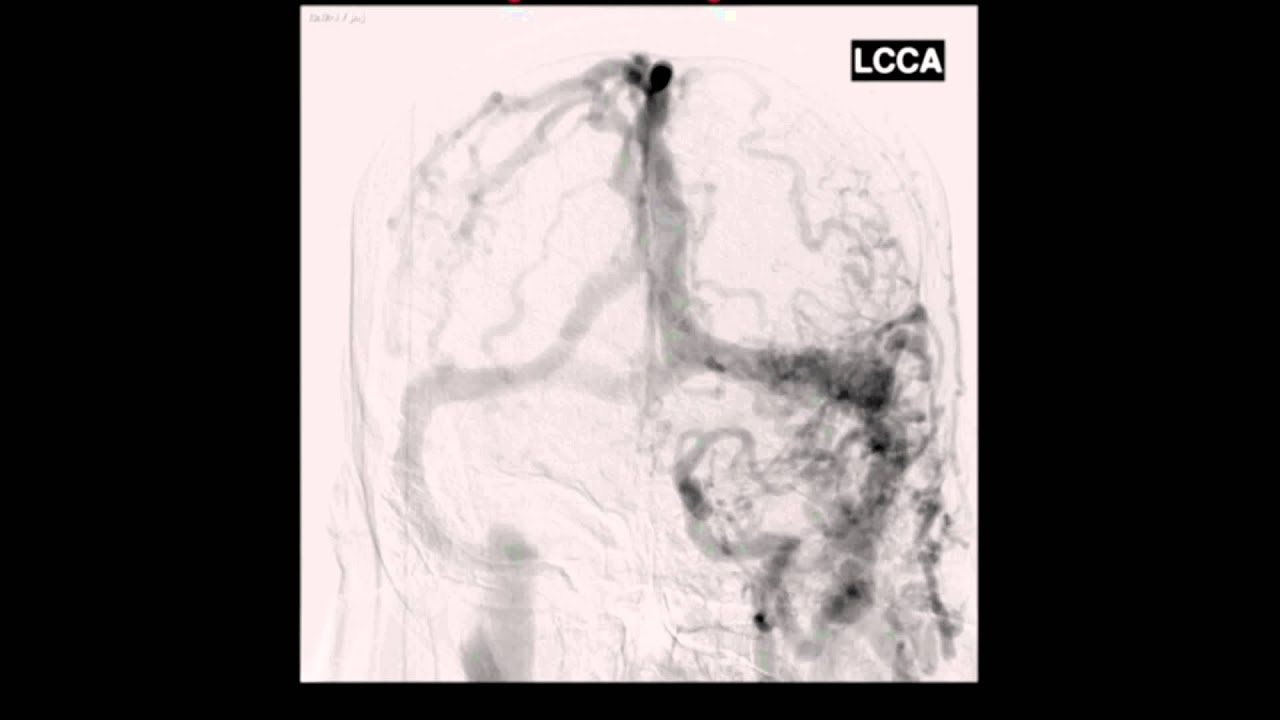 Endovascular treatment of complex dural arteriovenous fistula using the ...