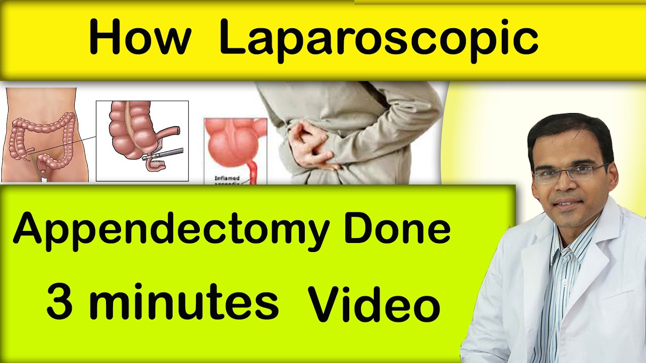 How Laparoscopic Appendectomy Done? 3 Minutes Video - YouTube