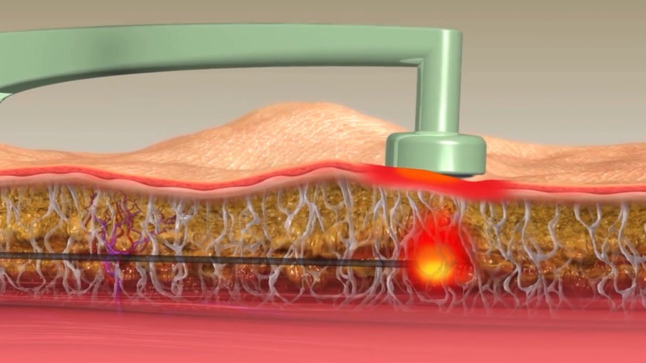 BodyTite explained by Dr. Shalini Gupta with Amy Scalia of CincyChic ...