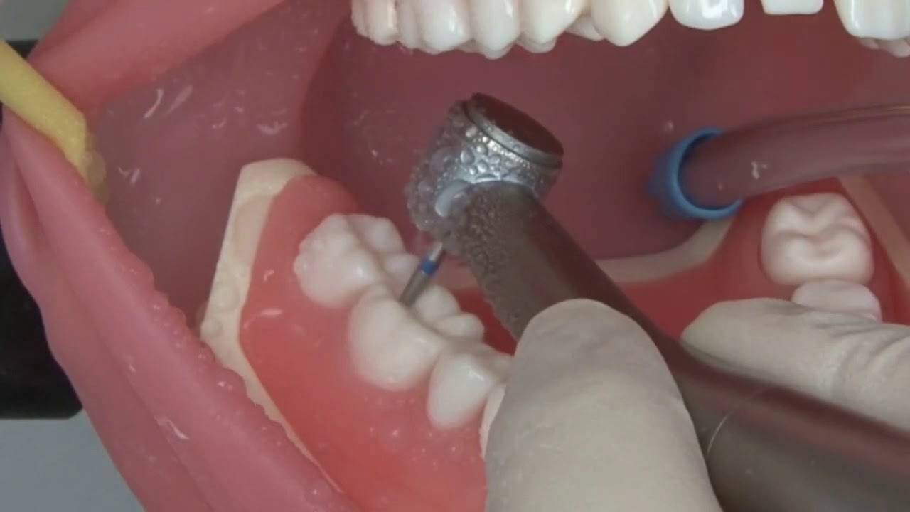 MANI Inlay Preparation kit - YouTube