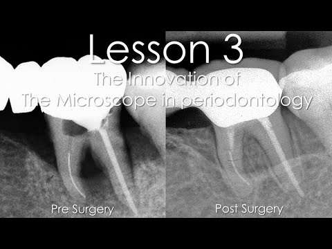 #MicroDentistry #MicroscopicPeriodontology #歯周病 #歯周病治療 #顕微鏡歯科 Lesson 3 ...