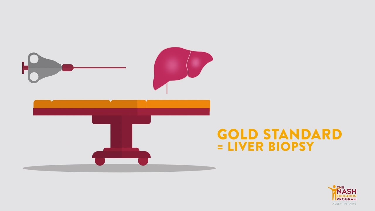 Biopsy: the gold standard for NASH diagnosis - YouTube