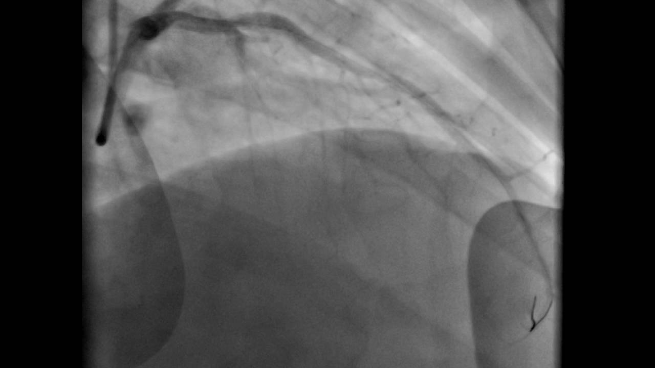 coronary artery perforation - YouTube