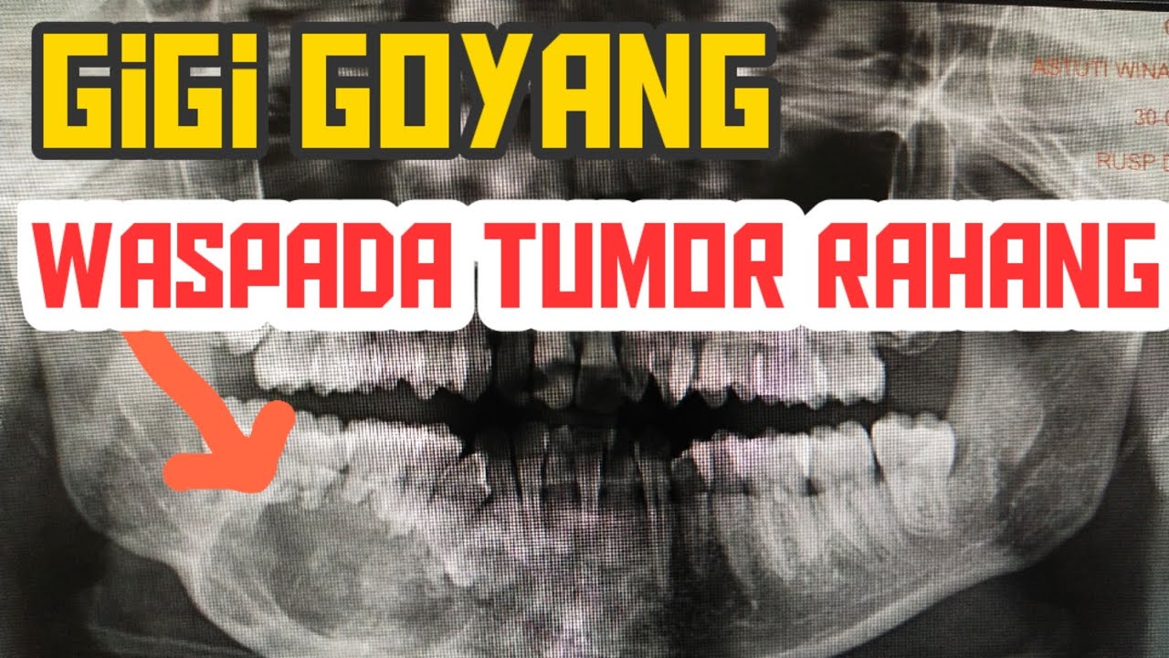 Biopsi tumor rahang | ameloblastoma mandibula - YouTube