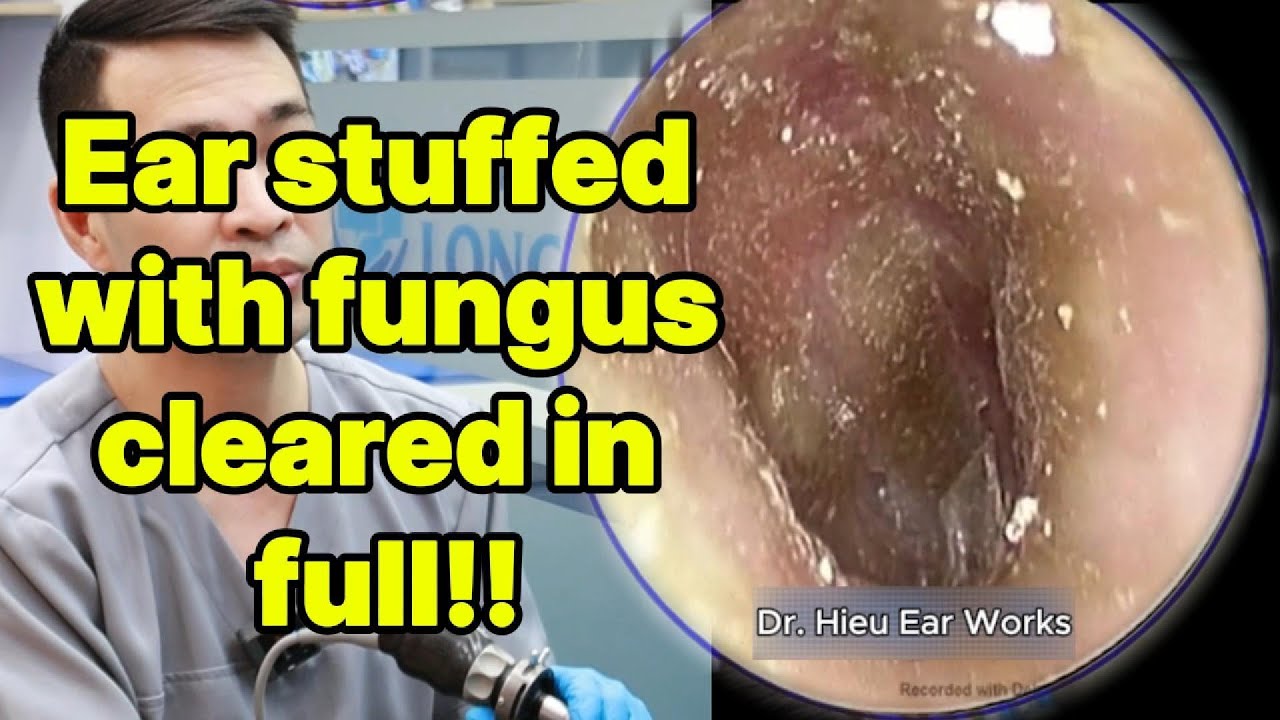 Ear stuffed with fungus cleared in full | ear cleaning | ASMR earwax ...