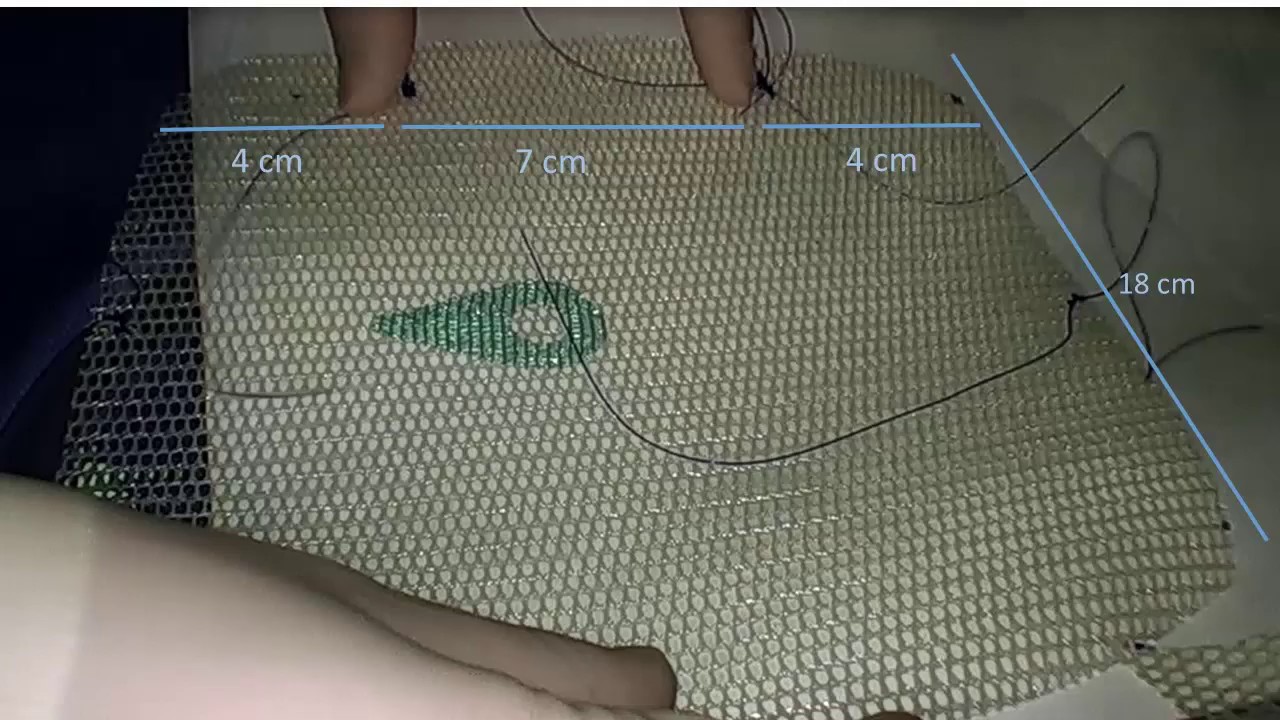 Sugarbaker repair after radical cystectomy + Bricker reconstruction ...