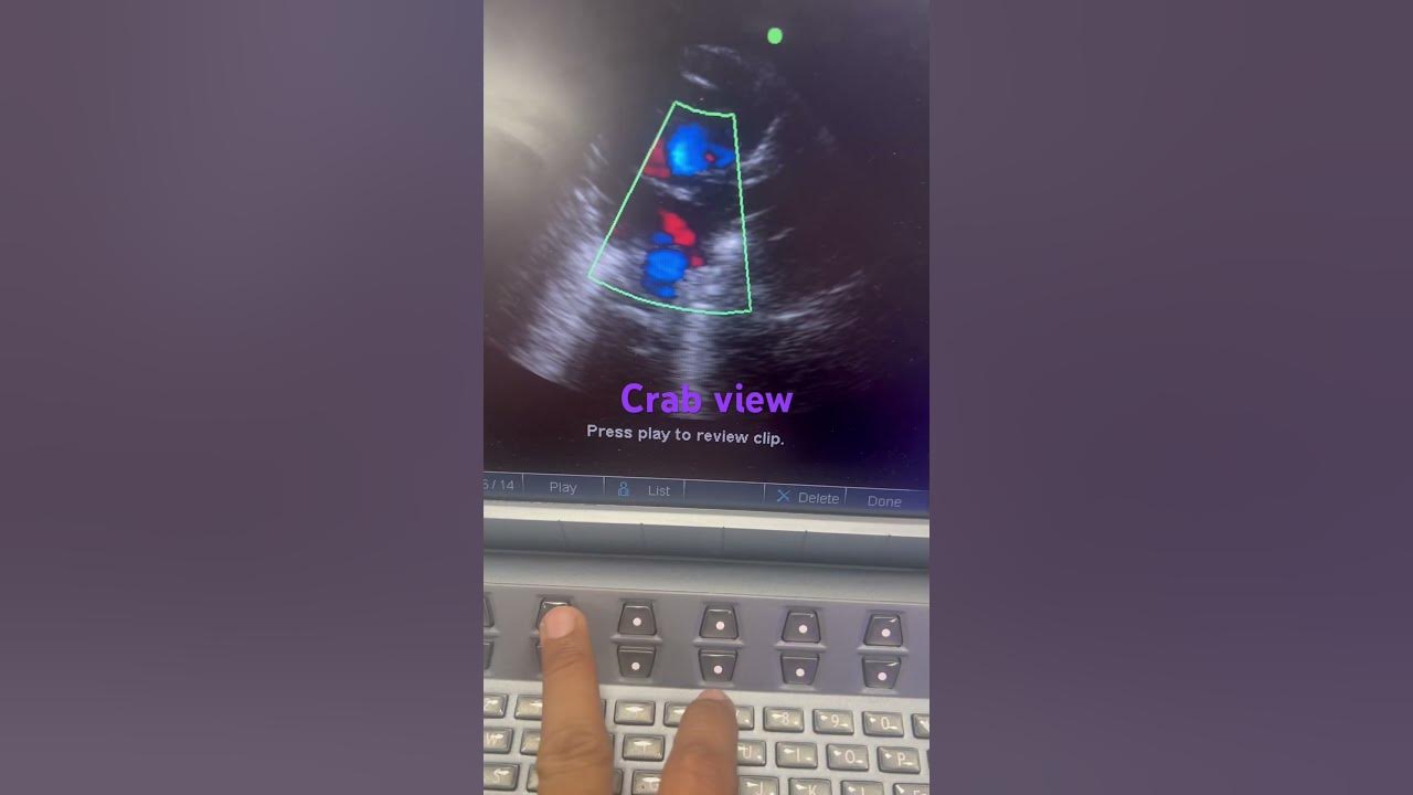 Neonatal echo- Crab view - all four pulmonary veins visible. - YouTube