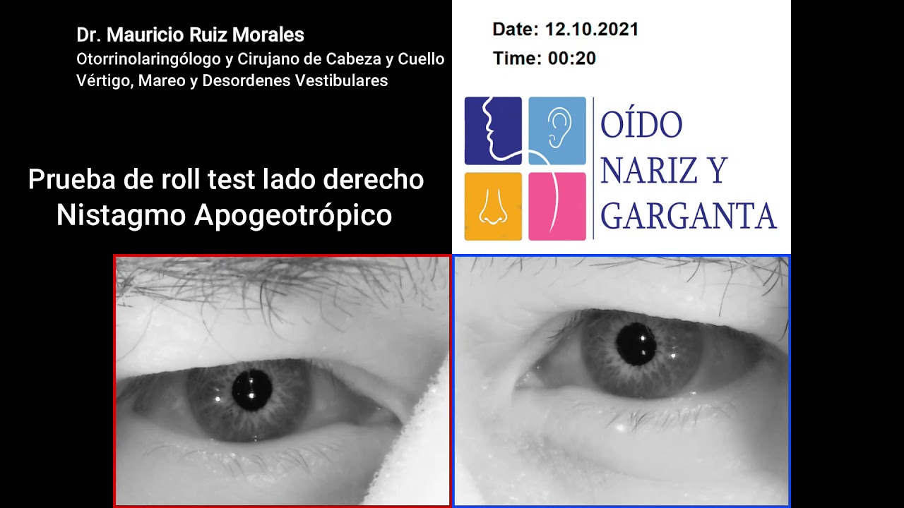 Vértigo Postural Paroxístico Benigno - Cupulolitiasis de Canal ...