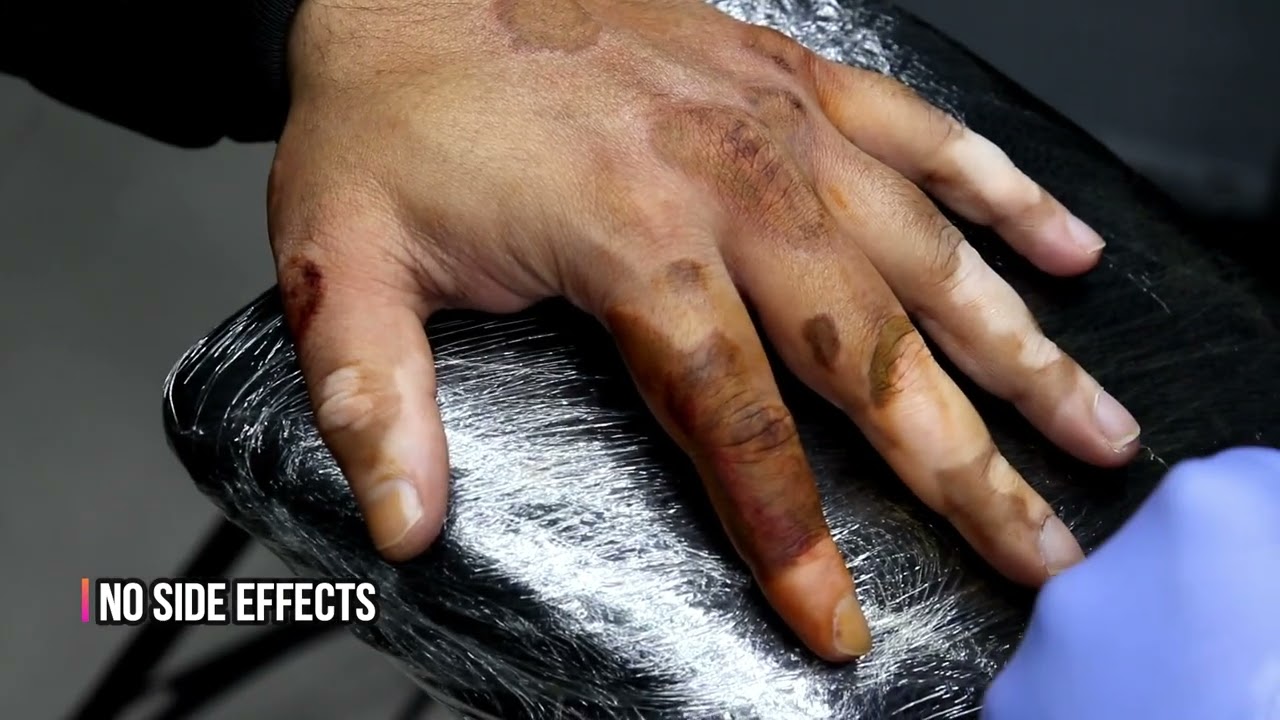 Permanent Makeup for Vitiligo - Vitiligo Cover Up Tattoo - Micro ...