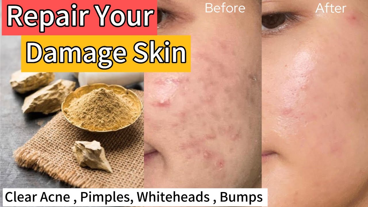 Multani Mitti Face Pack for Acne | Clear Skin Naturally | Get Glowing ...