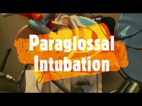 Vie Scope® Paraglossal Intubation (Off-Molar Intubation) - YouTube