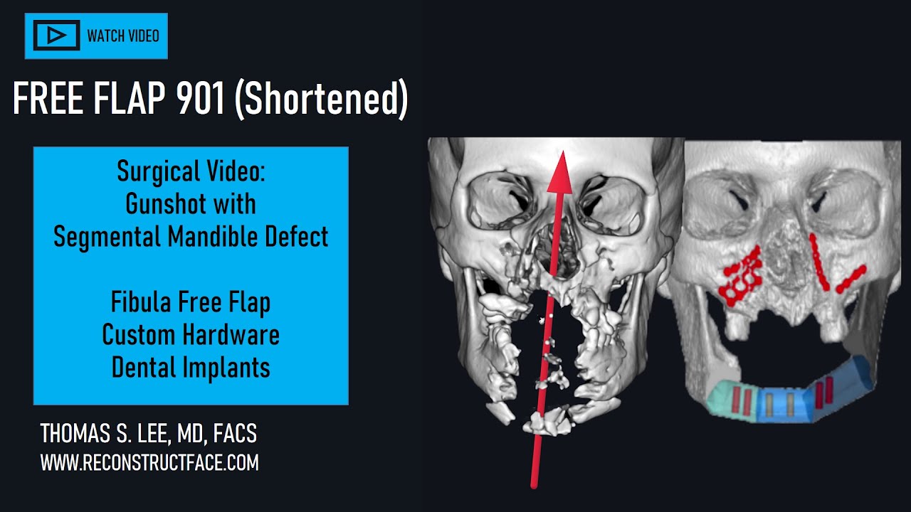 Surgery: Lower Face Recon after Gunshot: Pec Flap, Fibula Flap [901 ...
