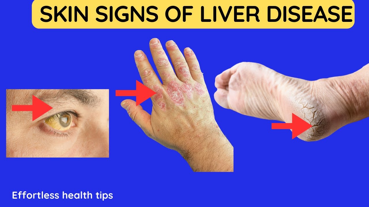 12 Unusual skin signs of liver disease - YouTube