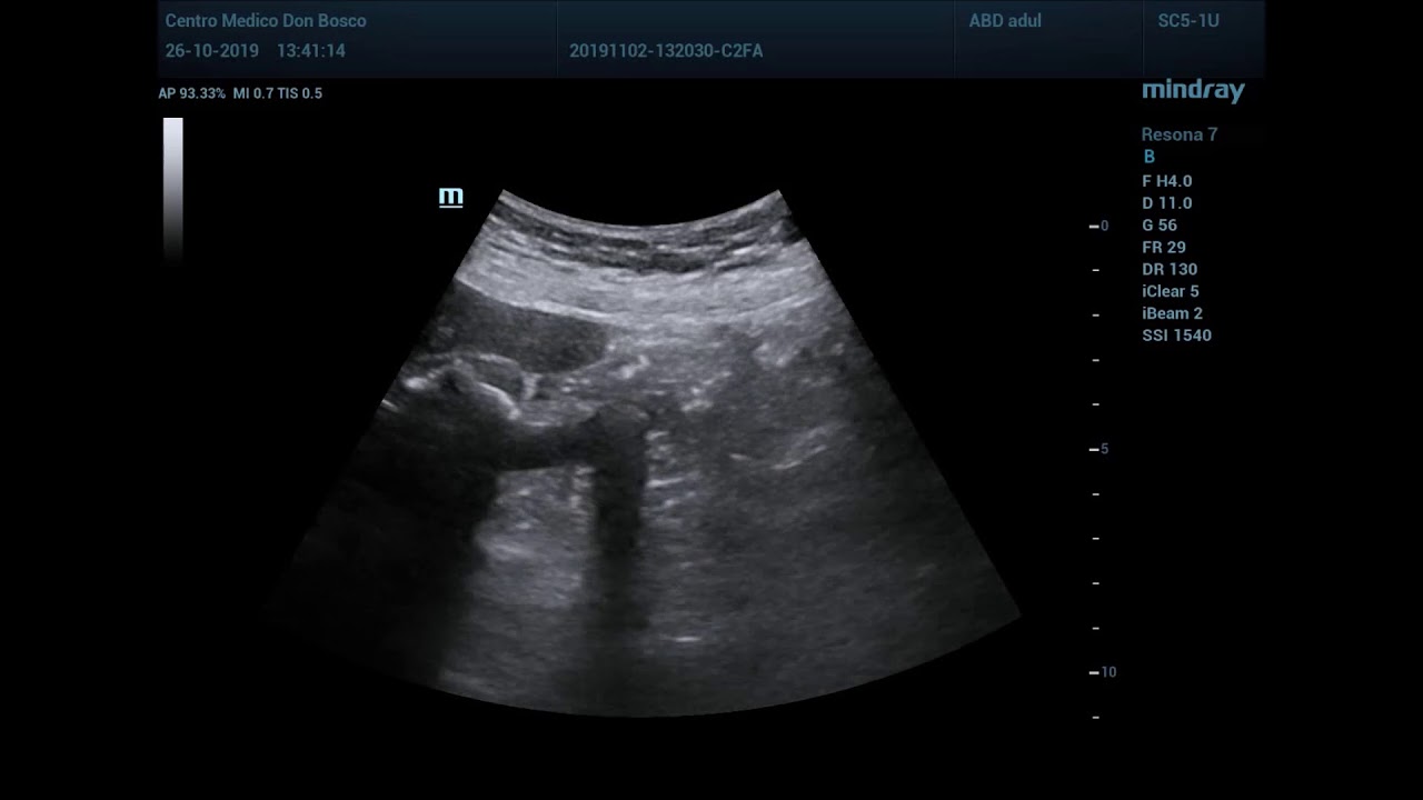 Ecografia Calcolosi del Coledoco e della Colecisti - YouTube