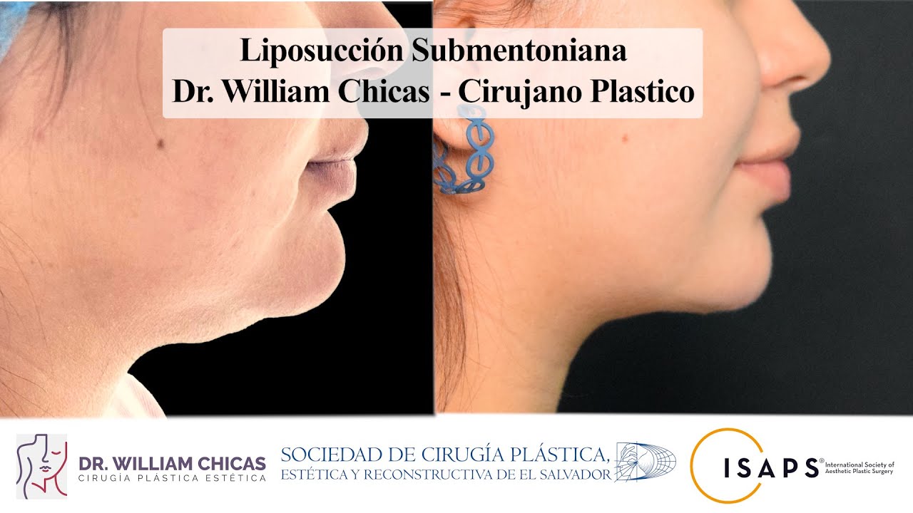 Liposuccion papada (submentoniana y jowls) - Dr. William Chicas ...