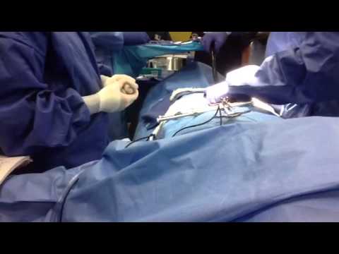 Part 3 of Bowel Resection - YouTube