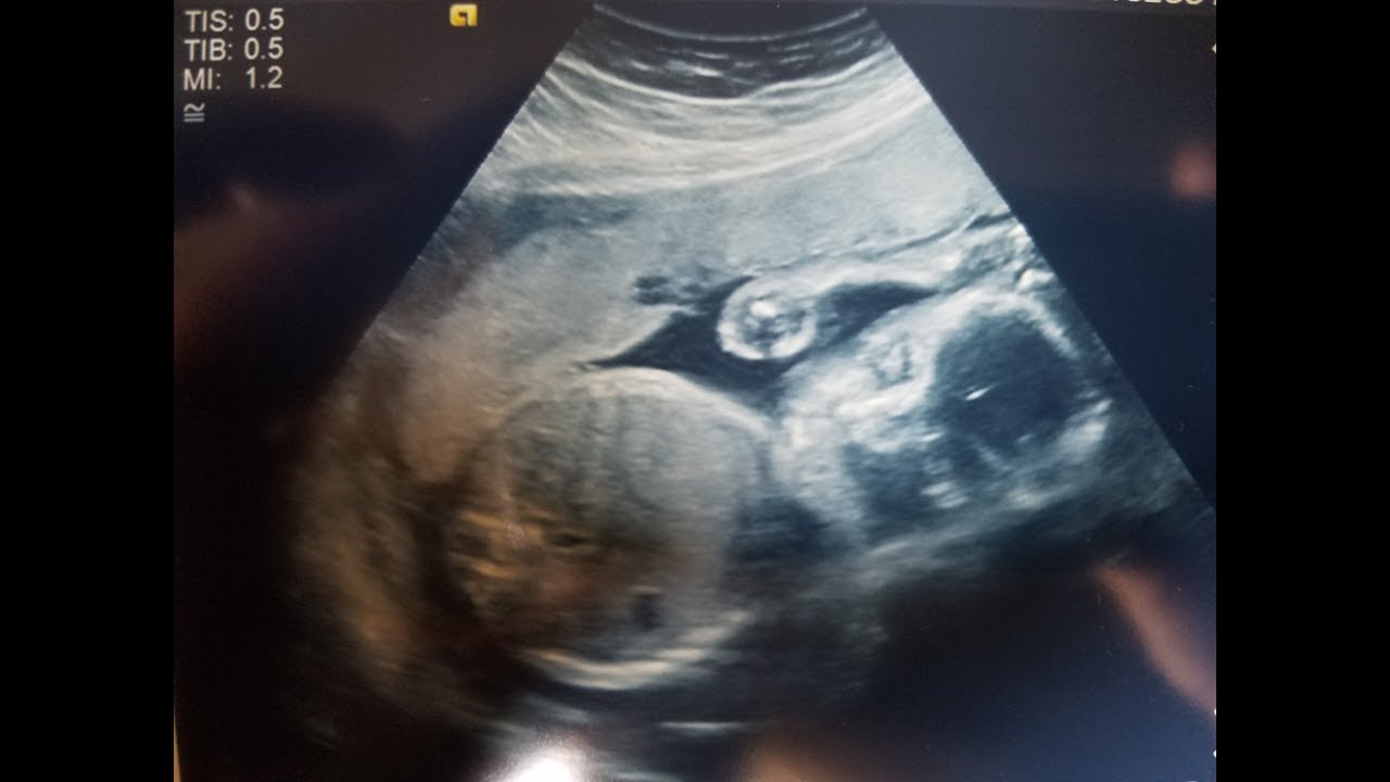 Had An Ultrasound Today & Got More Chickens - YouTube