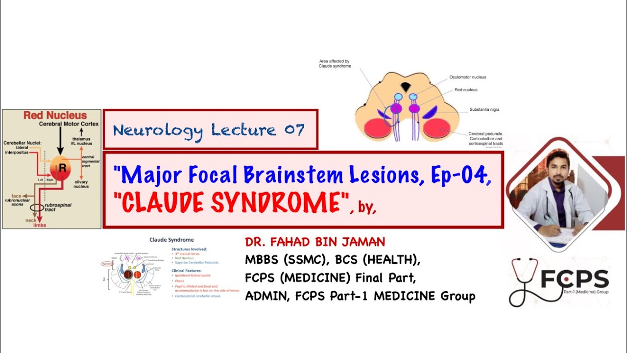 Easy & Exclusive Explanation on "CLAUDE SYNDROME" in 8 minutes ...