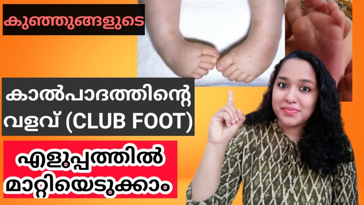 How To Treat Club Foot at home/easy tips for clubfoot - YouTube