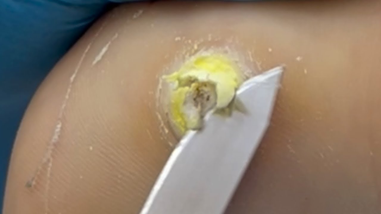 A Yellow Wart On The Sole Of My Foot, I Cut It Off Little By Little ...