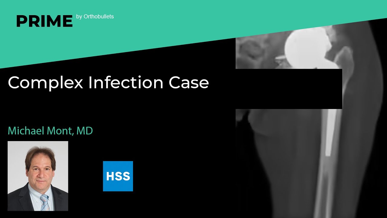 Complex Infection Case - Michael A. Mont, MD - YouTube