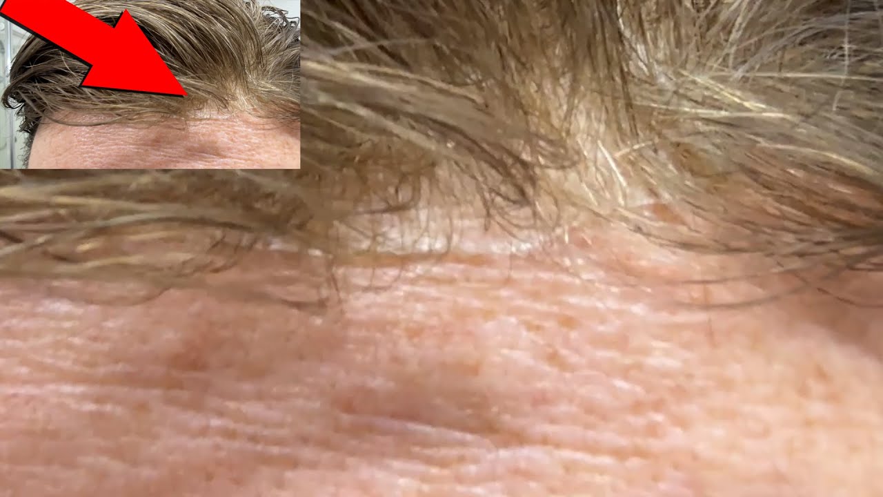 Plastic Hairline Problem - YouTube