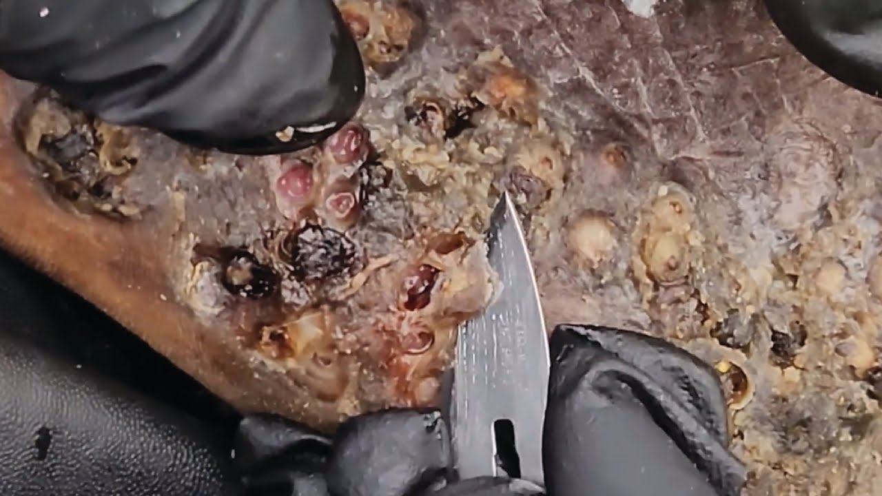 Histopathology of Severe Jigger Infected Person in 2025 - YouTube